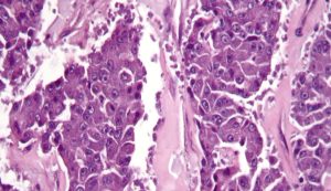 Understanding Acinar Cell Carcinoma of the Pancreas | Massive Bio